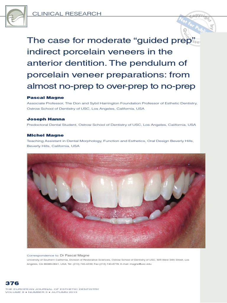 The Case For Moderate "Guided Prep" Indirect Porcelain Veneers in The ...
