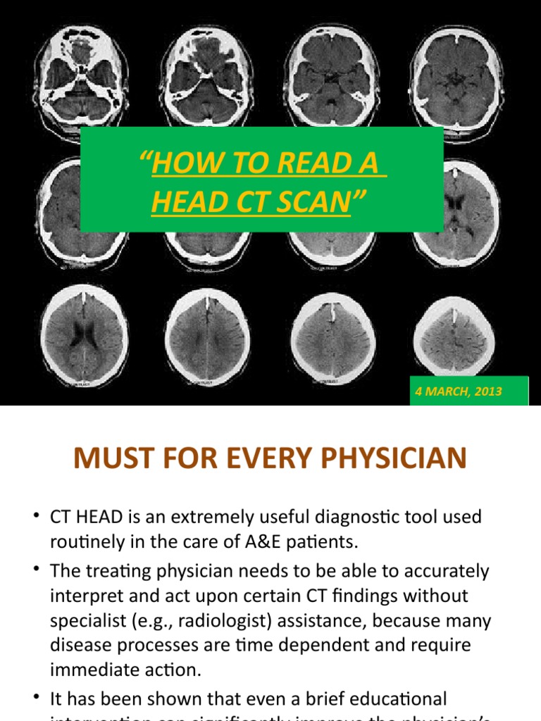 Reading Normal Head CT Scans | PDF | Ct Scan | Parietal Lobe