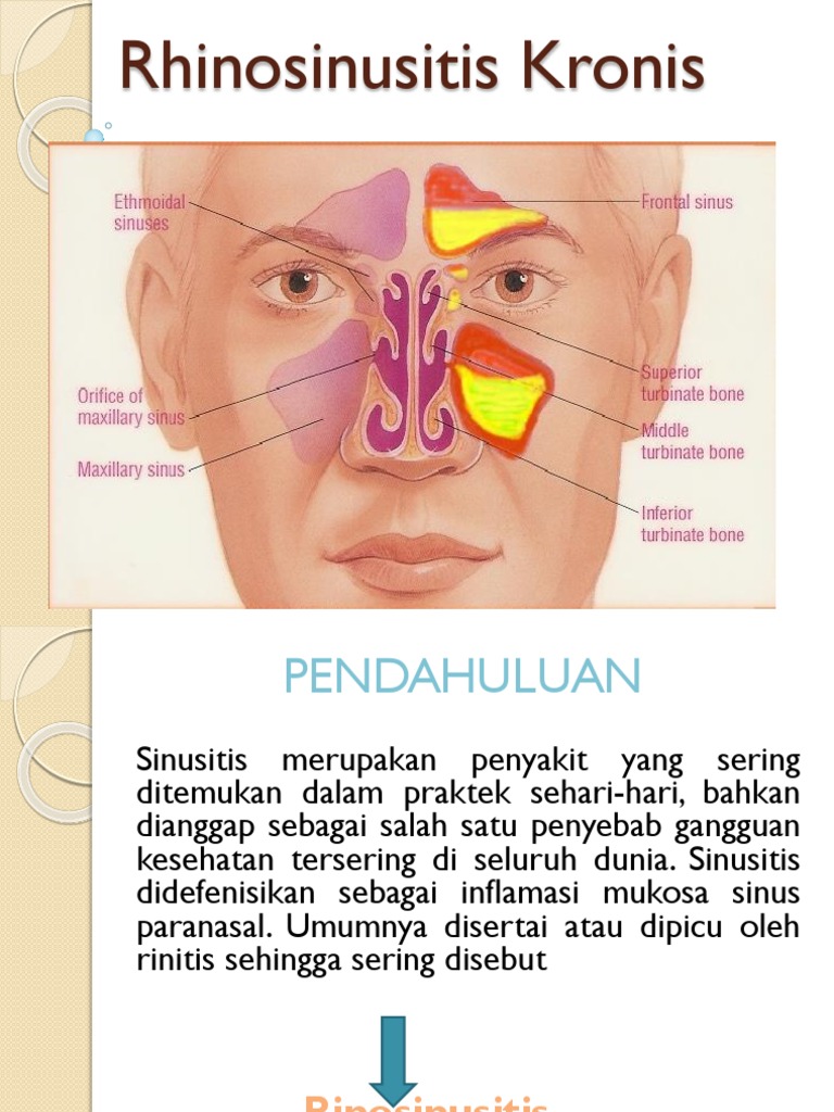 KRITERIA DIAGNOSIS RINOSINUSITIS KRONIS | PDF