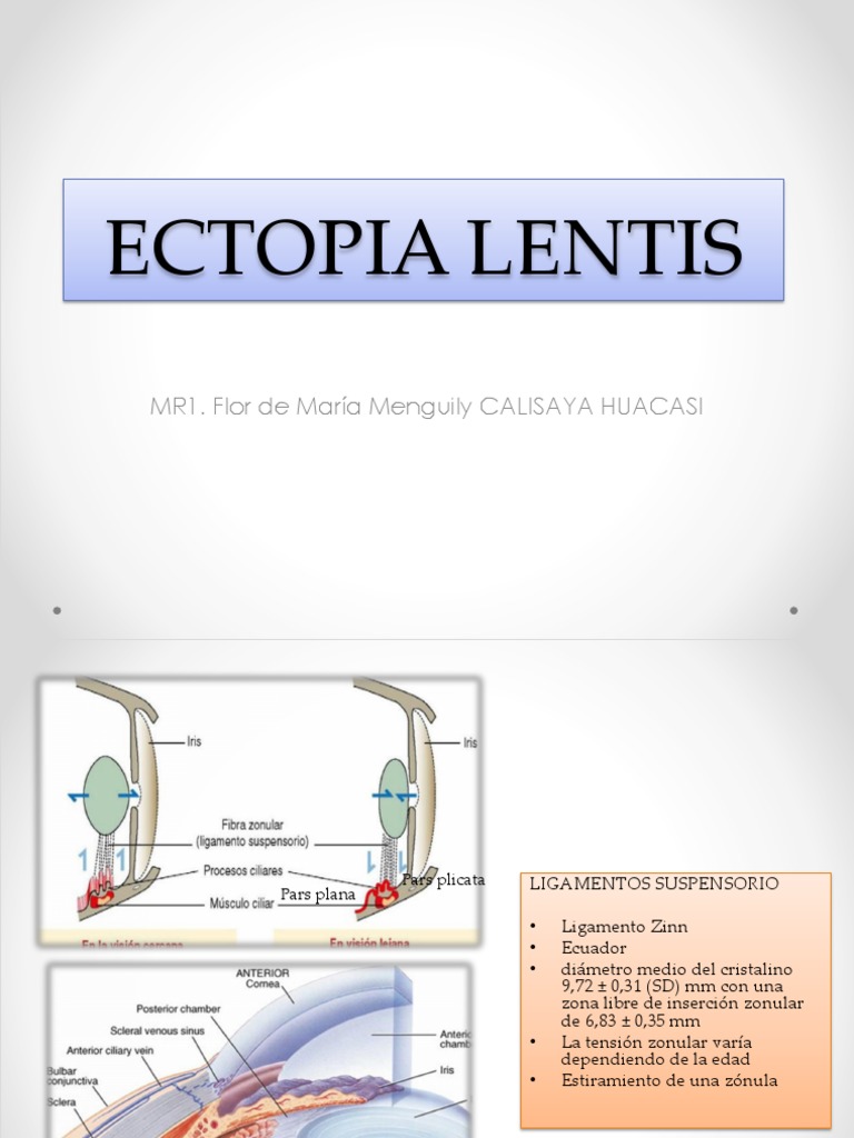 Ectopia Lentis: Causas y Tratamientos | PDF | Ojo humano | Glaucoma