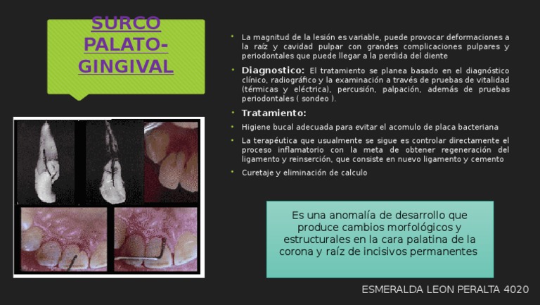 Surco Palato Gingival