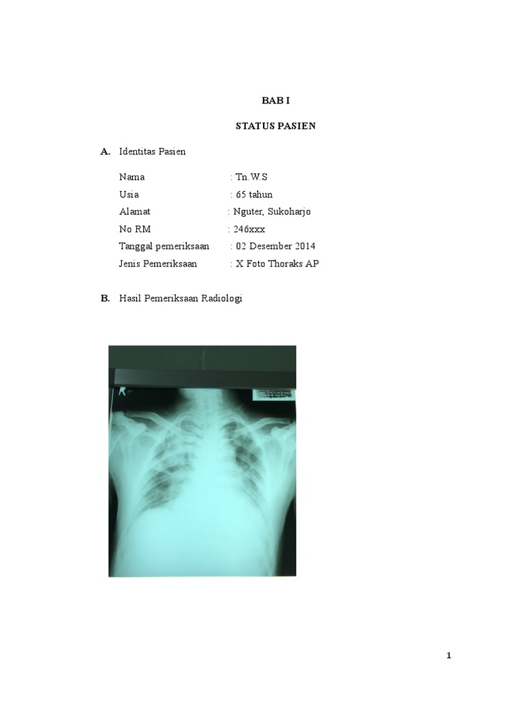 Case Report TB Paru | PDF