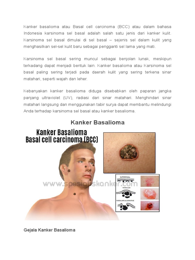 Kanker Basalioma Atau Basal Cell Carcinoma | PDF