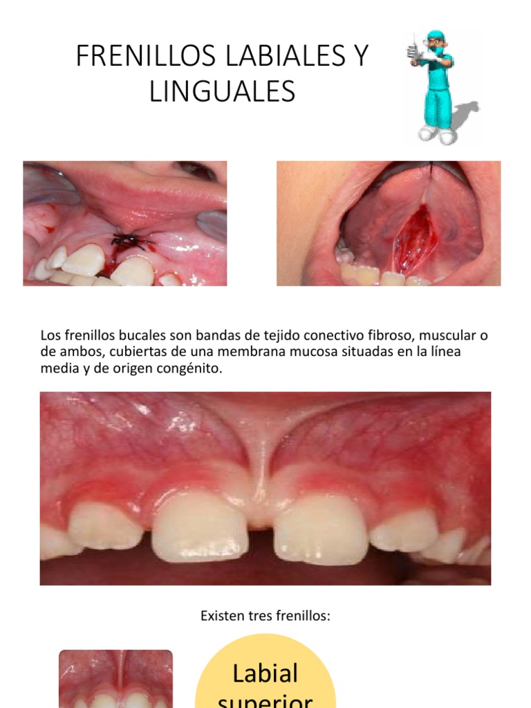 Frenillos bucales: técnicas quirúrgicas y patologías | PDF | Labio ...