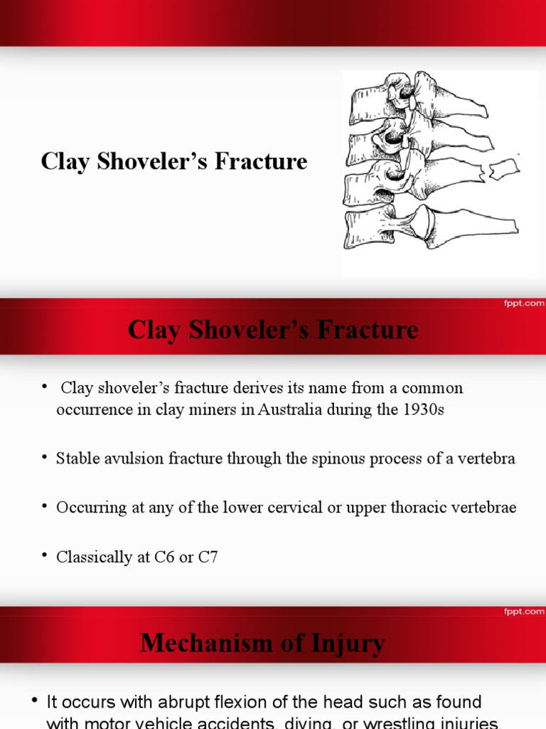 Clay Shoveler's Fracture | PDF | Vertebra | Vertebral Column