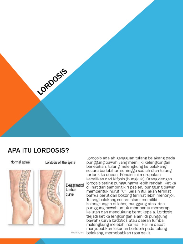 Lordosis | PDF