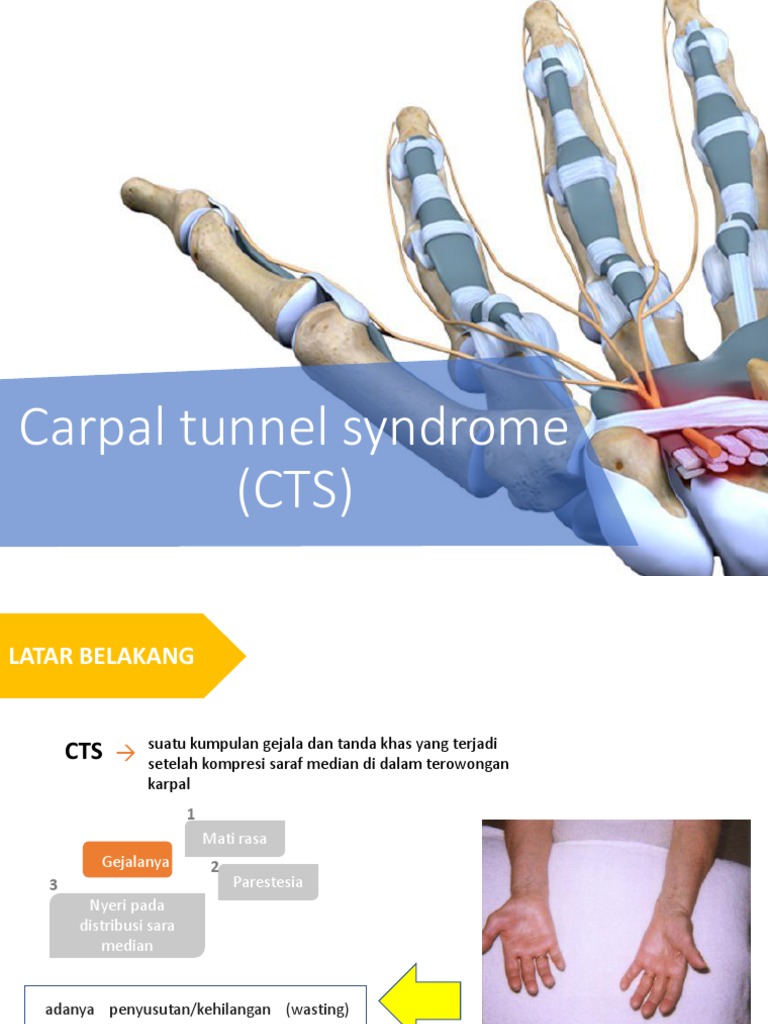 Carpal Tunnel Syndrome (CTS) | PDF