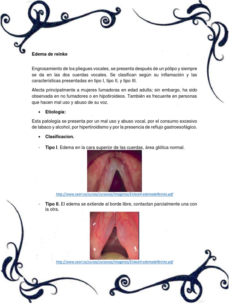 Tratamiento del Edema de Reinke | PDF | Cirugía | Nicotina