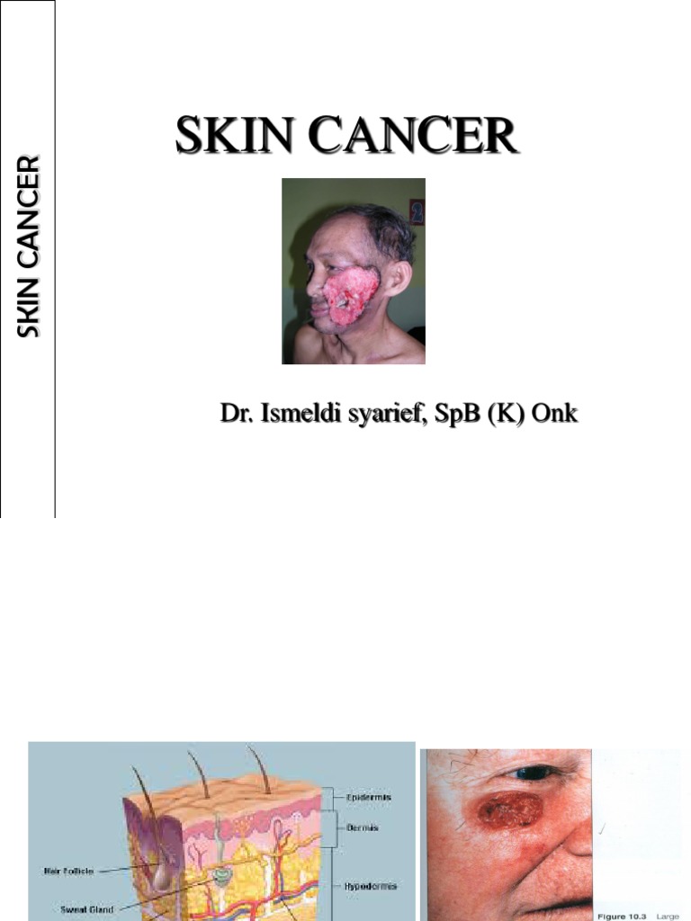 Everything You Need to Know About Skin Cancer | PDF | Melanoma | Skin ...