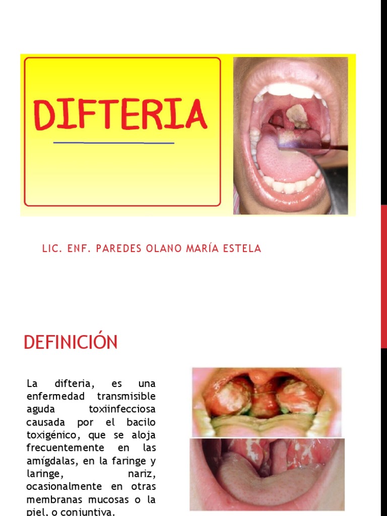 Difteria | PDF | Especialidades Medicas | Medicina CLINICA