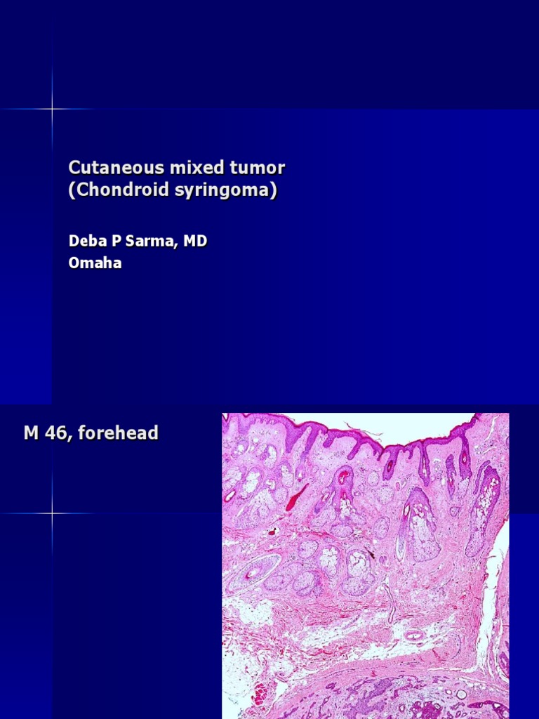 Cutaneous Mixed Tumor (Chondroid Syringoma), M 46, Forehead. | PDF