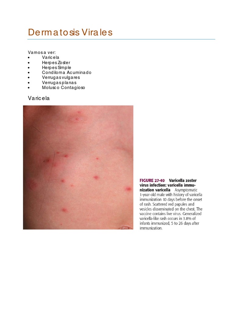 Varicela y Herpes Zoster en Niños | PDF | Medicina CLINICA | Medicina