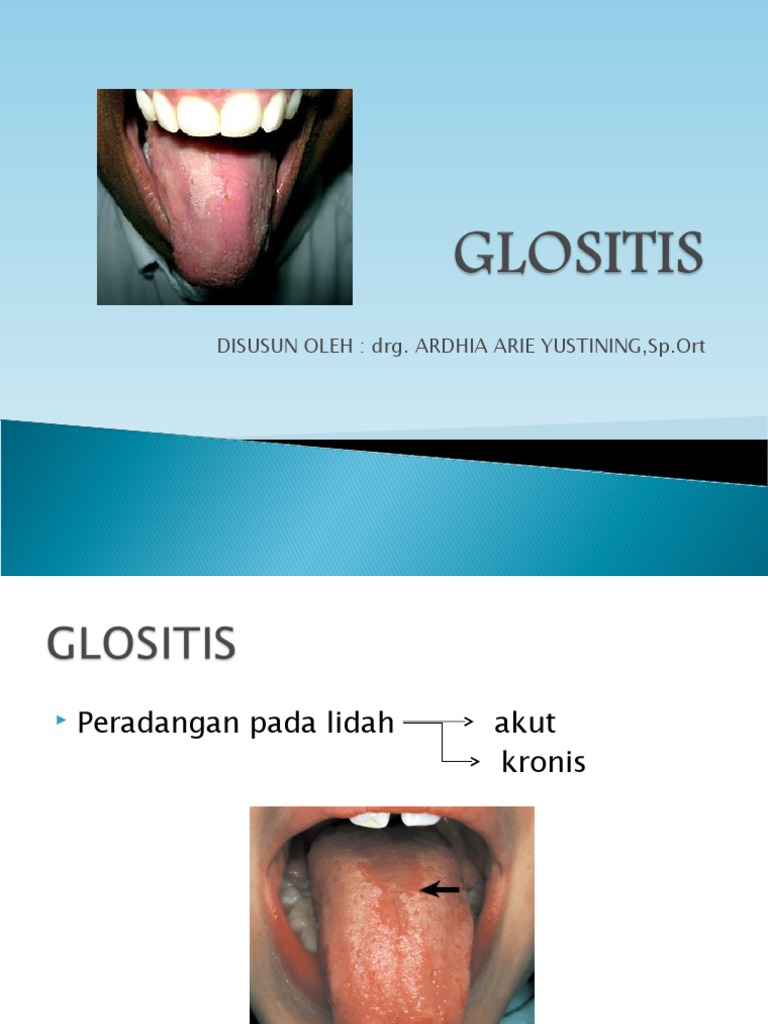 (Kuliah 16) Glositis | PDF