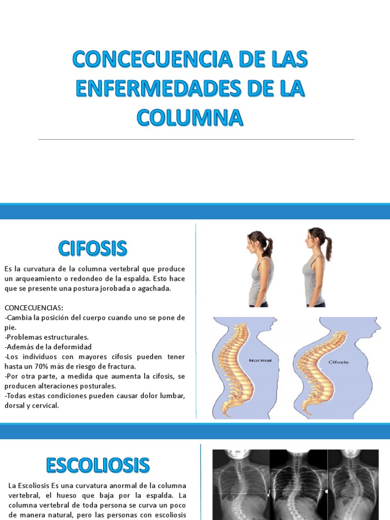 Enfermedades en La Columna | PDF