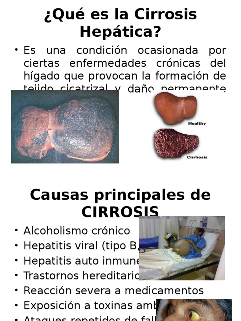 Diapositiva Cirrosis | PDF