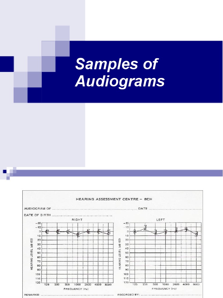 Samples of Audiograms | PDF