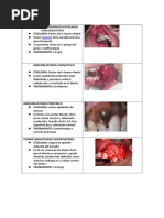 Infografia Abscesos Periapicales | PDF