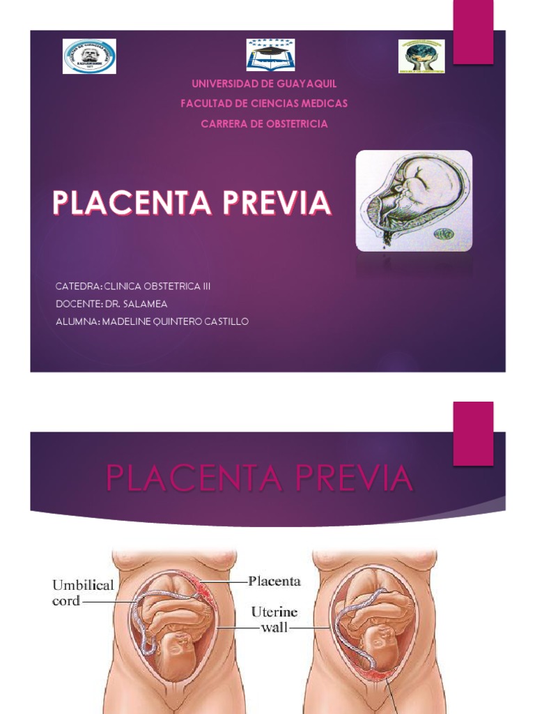 placenta-previa-exposicion.pptx | Placenta | Embarazo Mamífero | Prueba ...