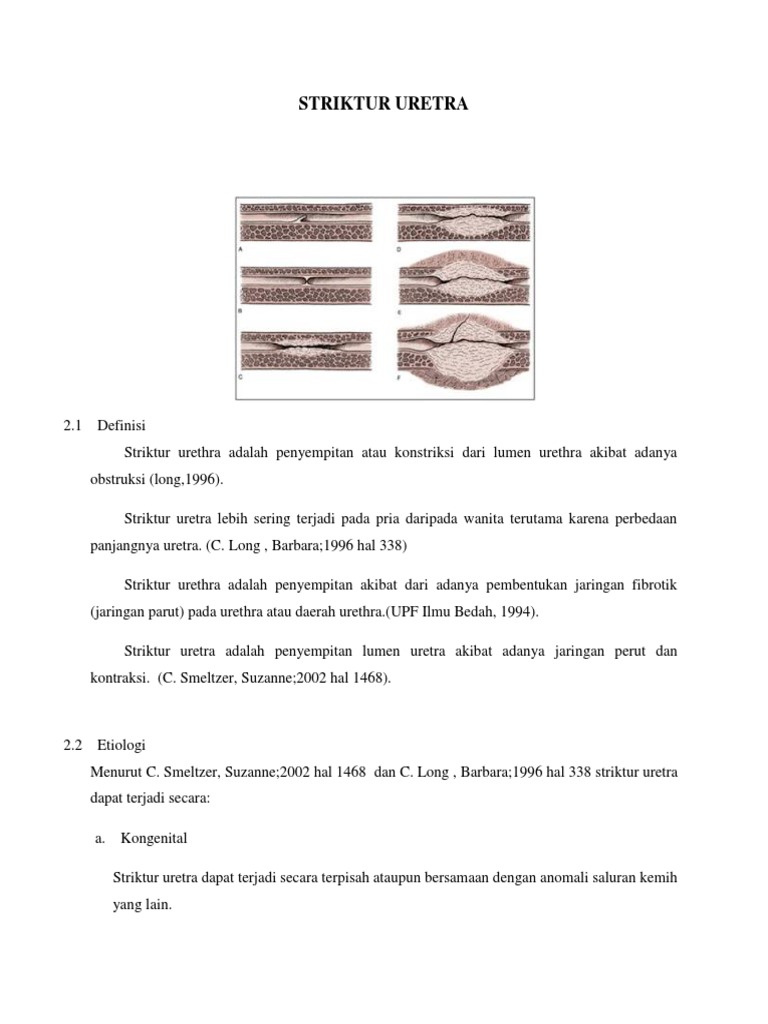 Striktur Uretra | PDF