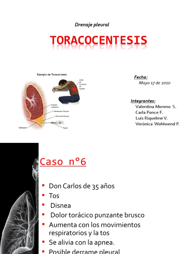 Toracocentesis | PDF | Tórax (anatomía humana) | Pulmón