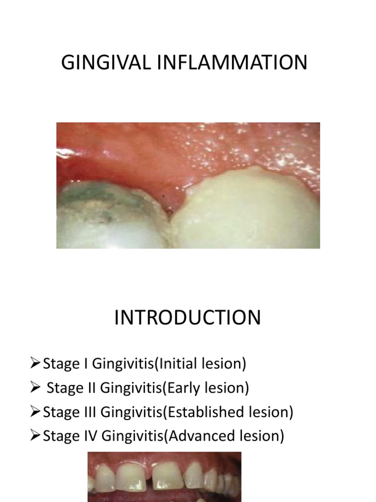 Gingival Inflammation | Inflammation | White Blood Cell