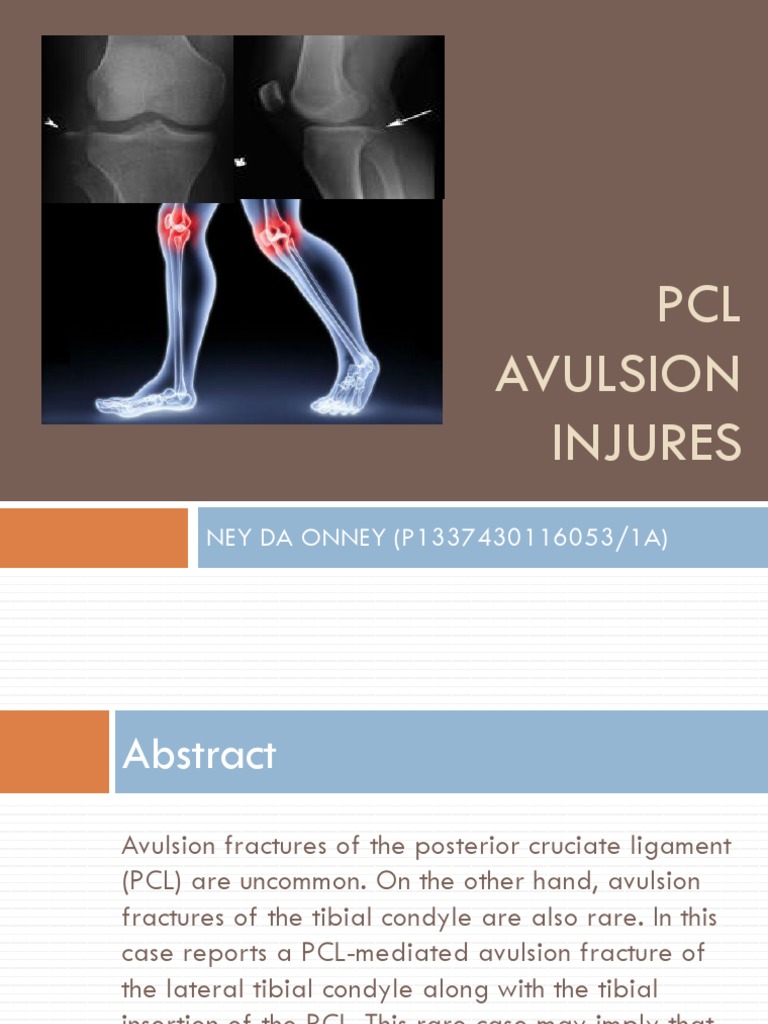 PCL's Avulsion Fracture | PDF | Knee | Human Anatomy
