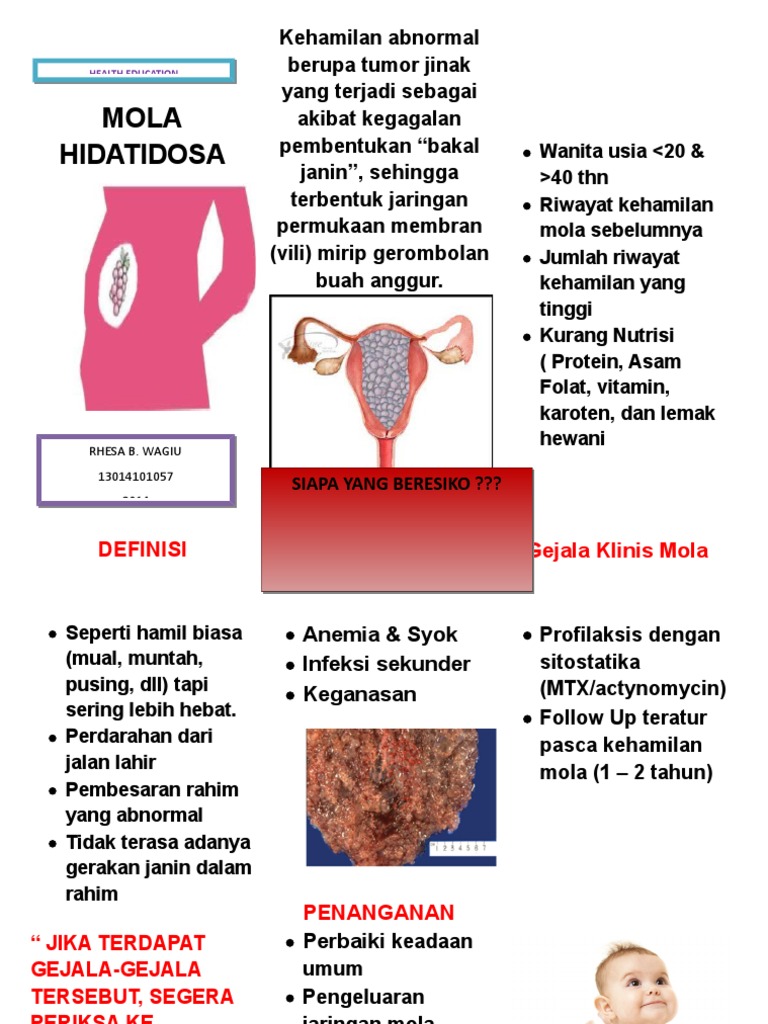Penanganan Mola Hidatidosa pada Wanita | PDF