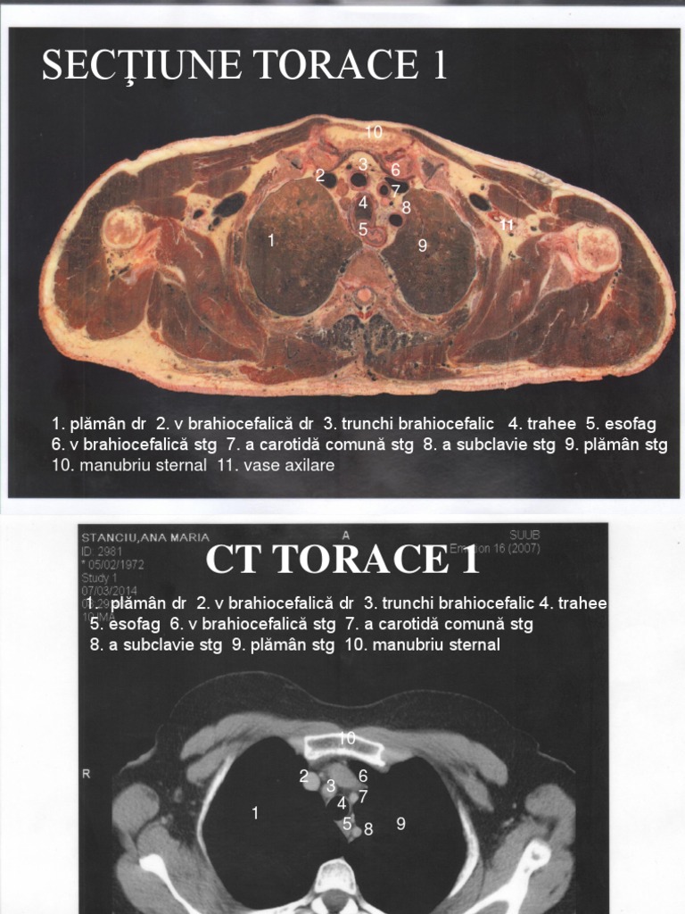 Sectiuni CT Torace | PDF