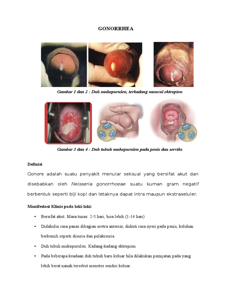 Gonorrhea: Gambar 1 Dan 2: Duh Mukopurulen, Terkadang Muncul Ektropion | PDF