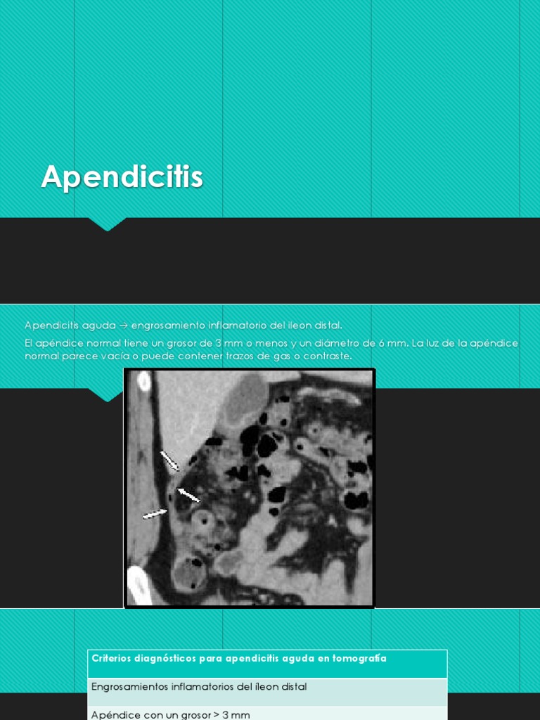 Apendicitis Tac | PDF