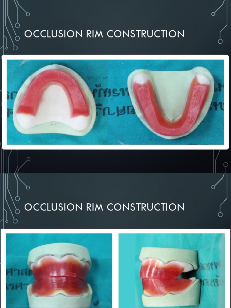 Occlusion Rim Construction | PDF