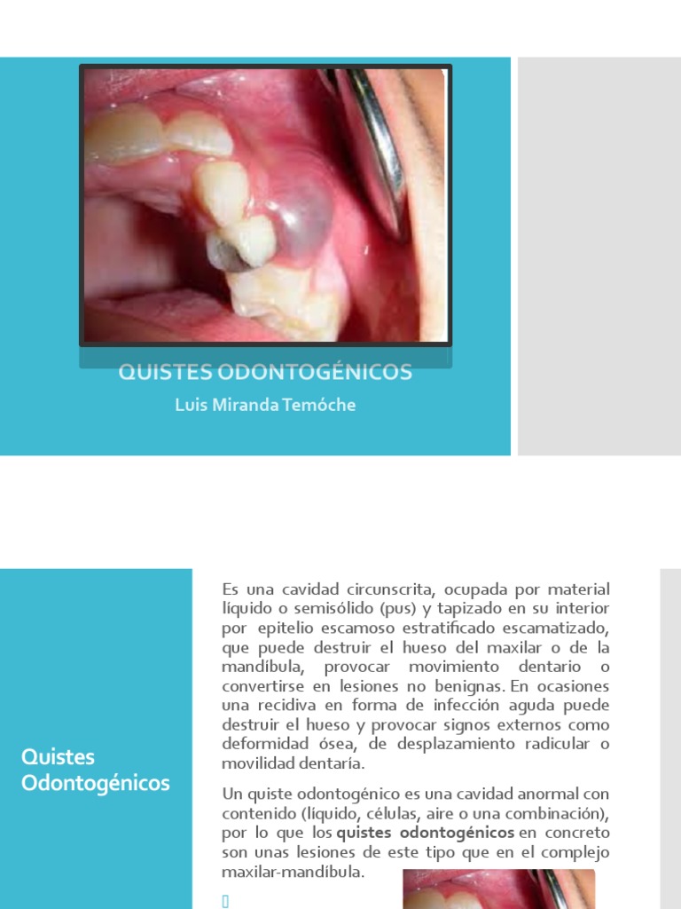 Quistes Odontogenicos Pdf Inflamación Epitelio