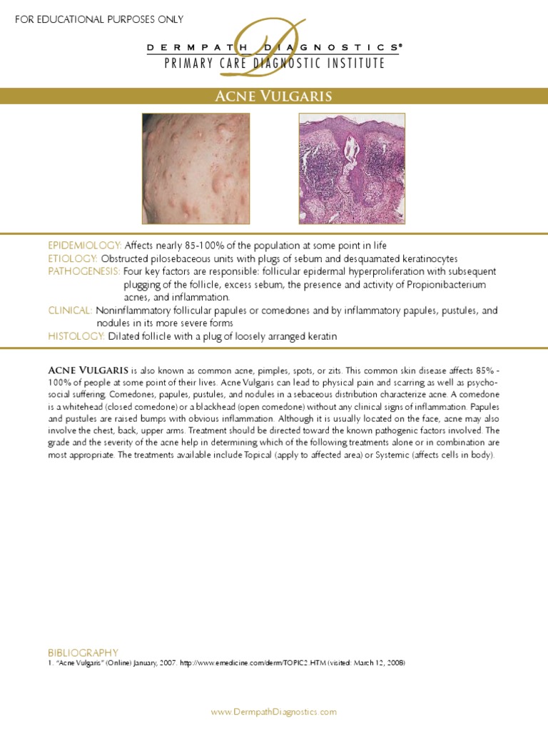 Acne Vulgaris | PDF | Integumentary System | Skin