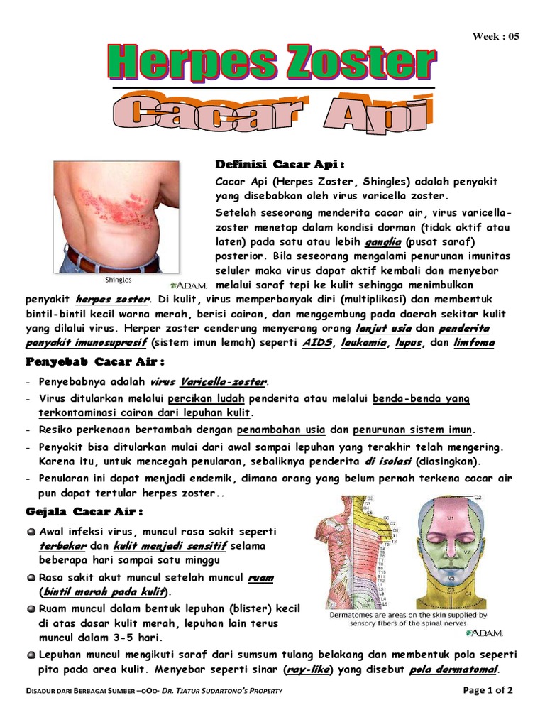Herpes Zoster - Cacar API | PDF
