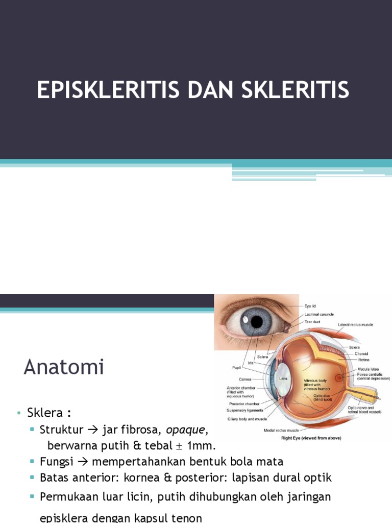 Episkleritis Skleritis | PDF