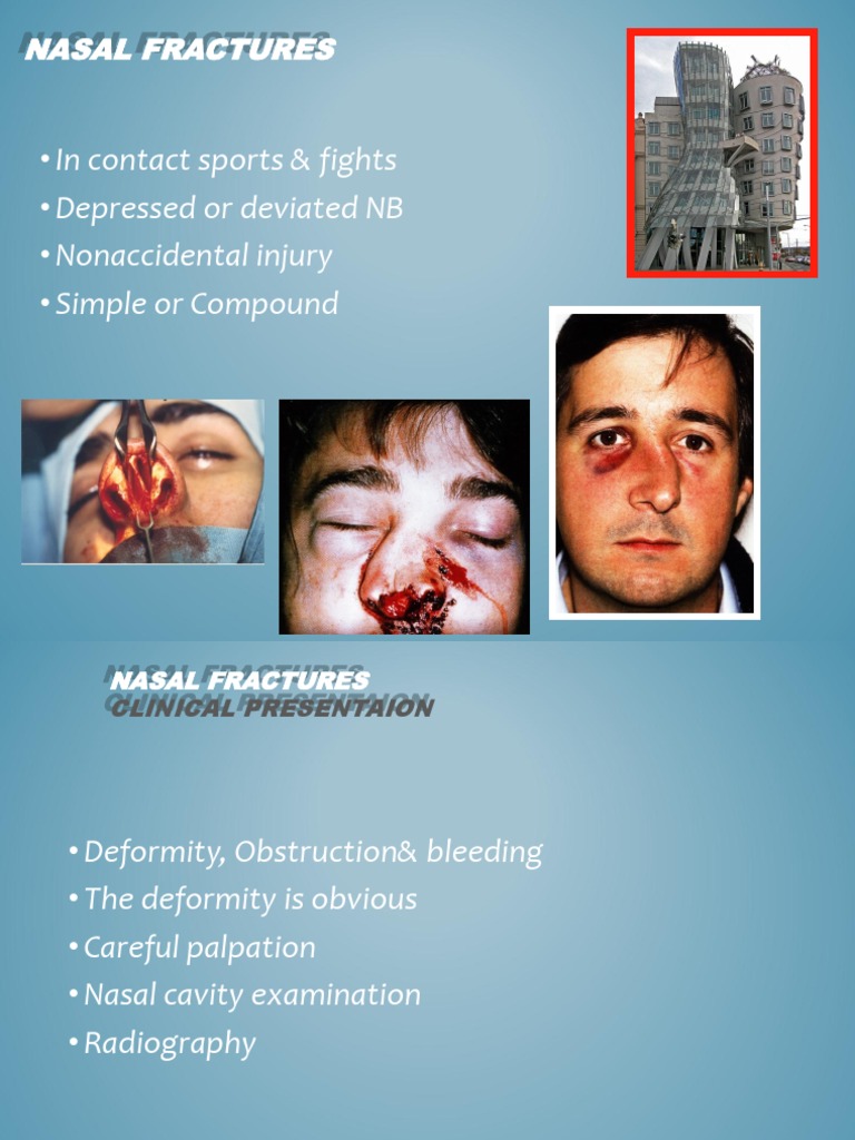 Nasal Fractures: Diagnosis and Treatment | PDF | Face | Human Anatomy