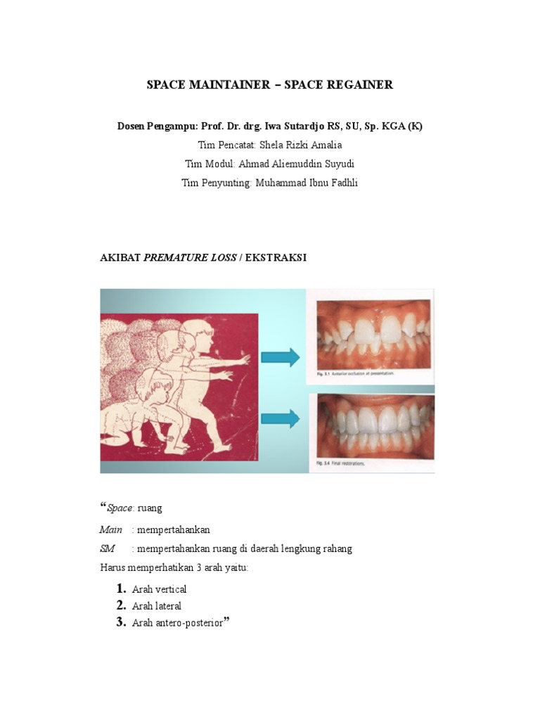 Space Maintainer - Space Regainer | PDF