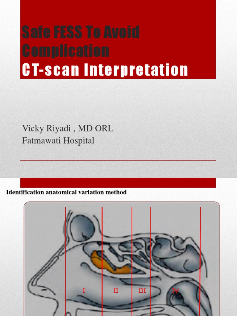 Safe FESS To Avoid Complication: CT-scan Interpretation | PDF | Human ...