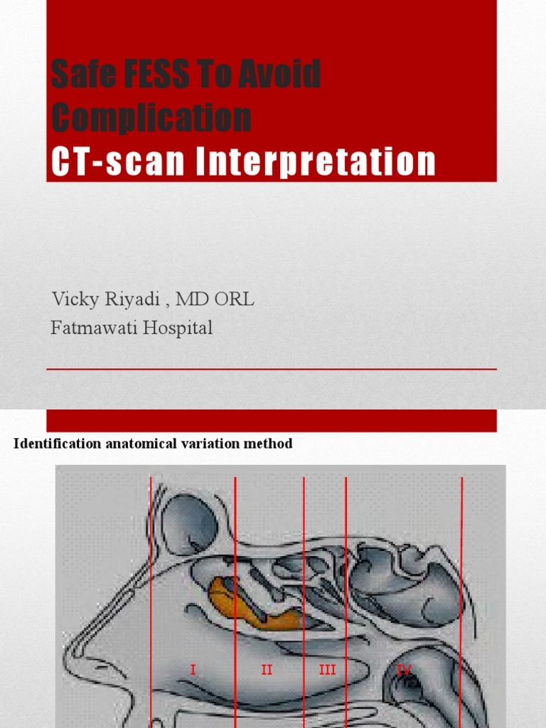 Safe FESS To Avoid Complication: CT-scan Interpretation | PDF | Human ...