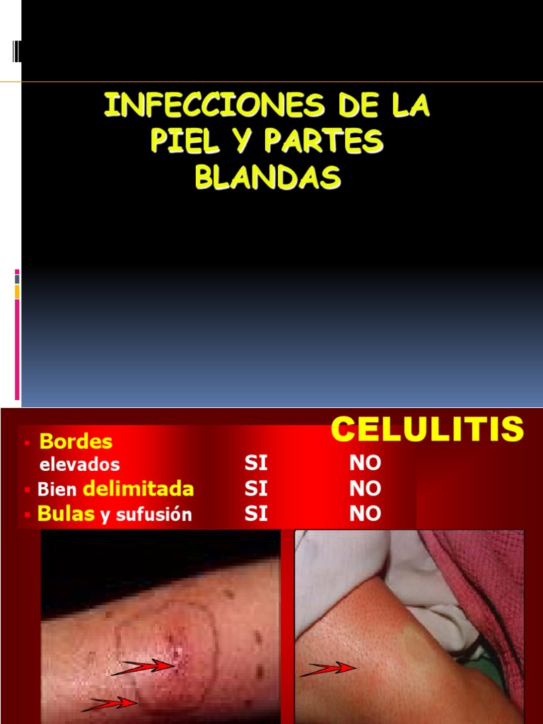 Infecciones de la Piel y Partes Blandas.ppt