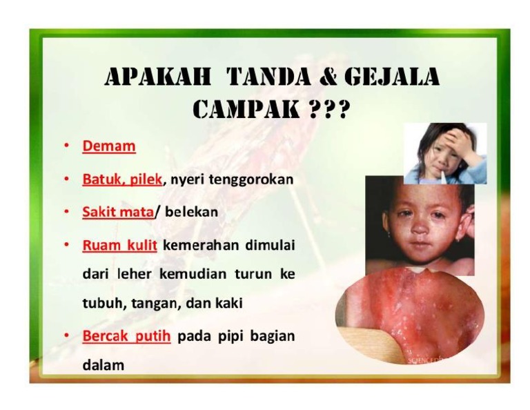 Tanda Gejala Campak | PDF