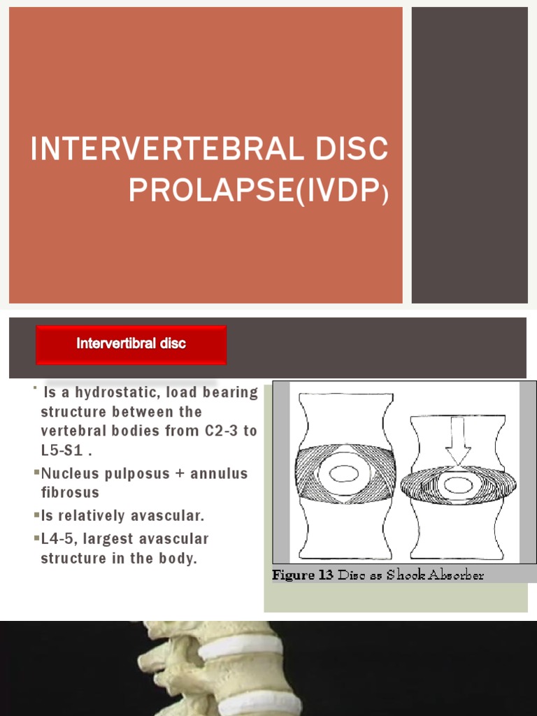 Intervertebral Disc Prolapse(Ivdp) | Vertebral Column | Nervous System