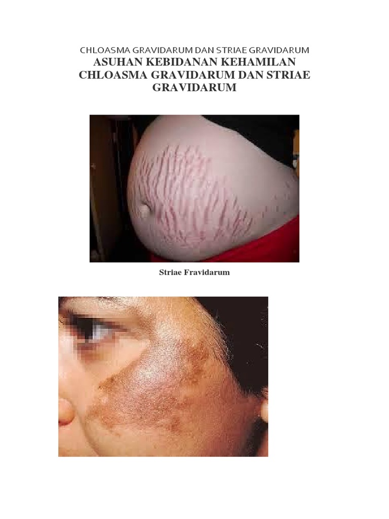Chloasma Gravidarum Dan Striae Gravidarum