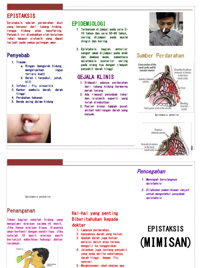 Epistaksis Leaflet | PDF