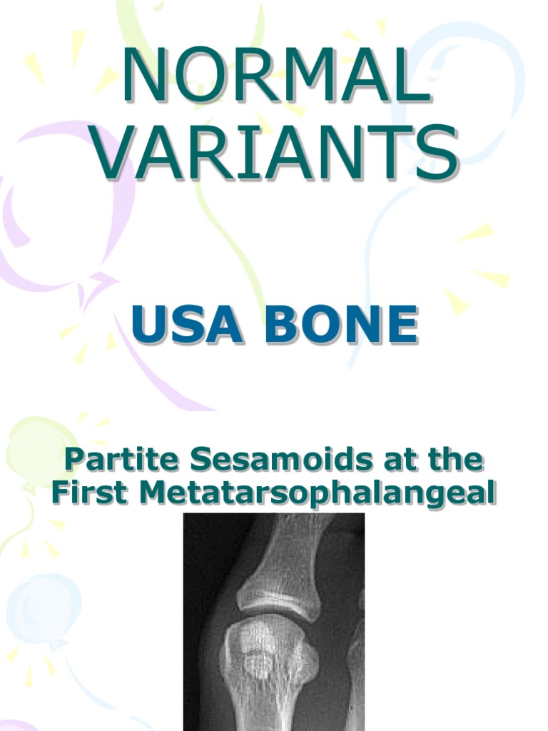 Normal Variants Usa Bone | PDF