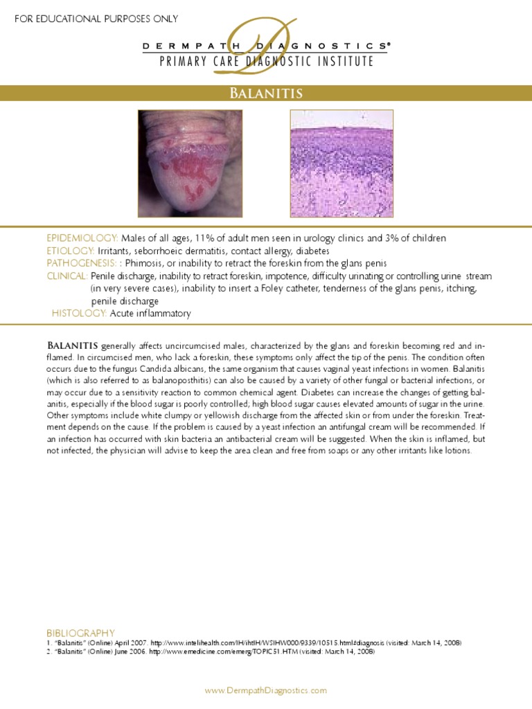 Understanding Balanitis in Males | PDF | Science & Mathematics
