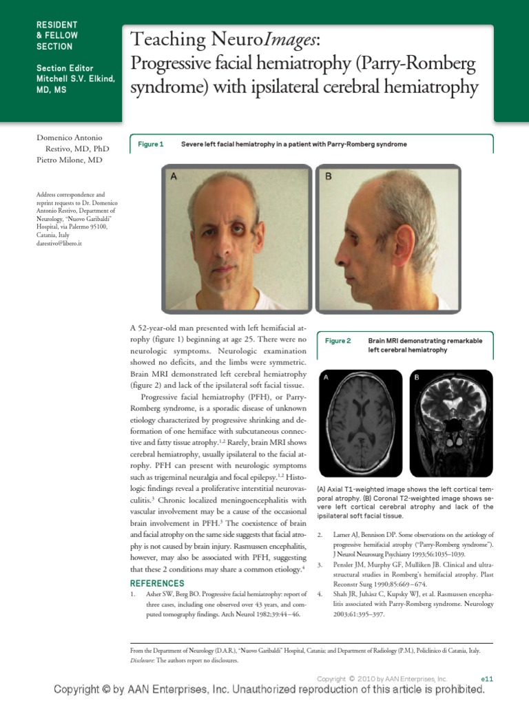 Teaching Neuroimages: Progressive Facial Hemiatrophy (Parry-Romberg ...