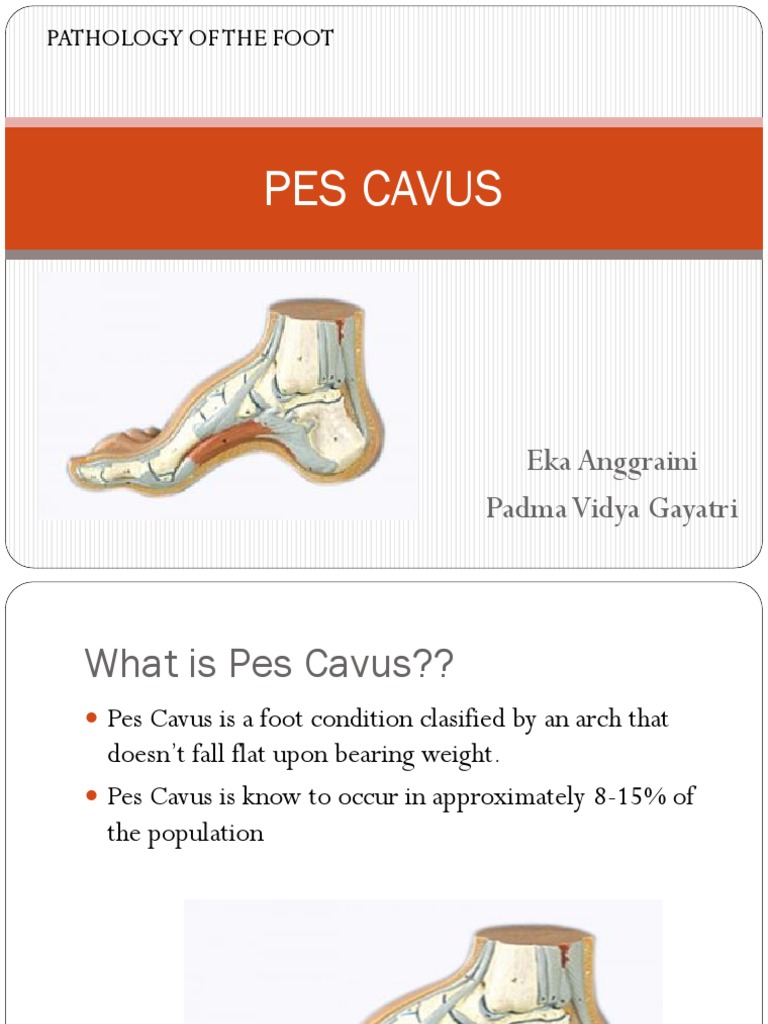 Pes Cavus | Foot | Musculoskeletal System