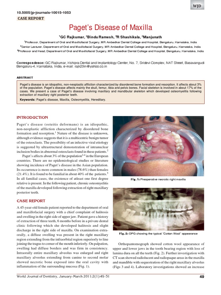 Pagets Disease Of The Jaw
