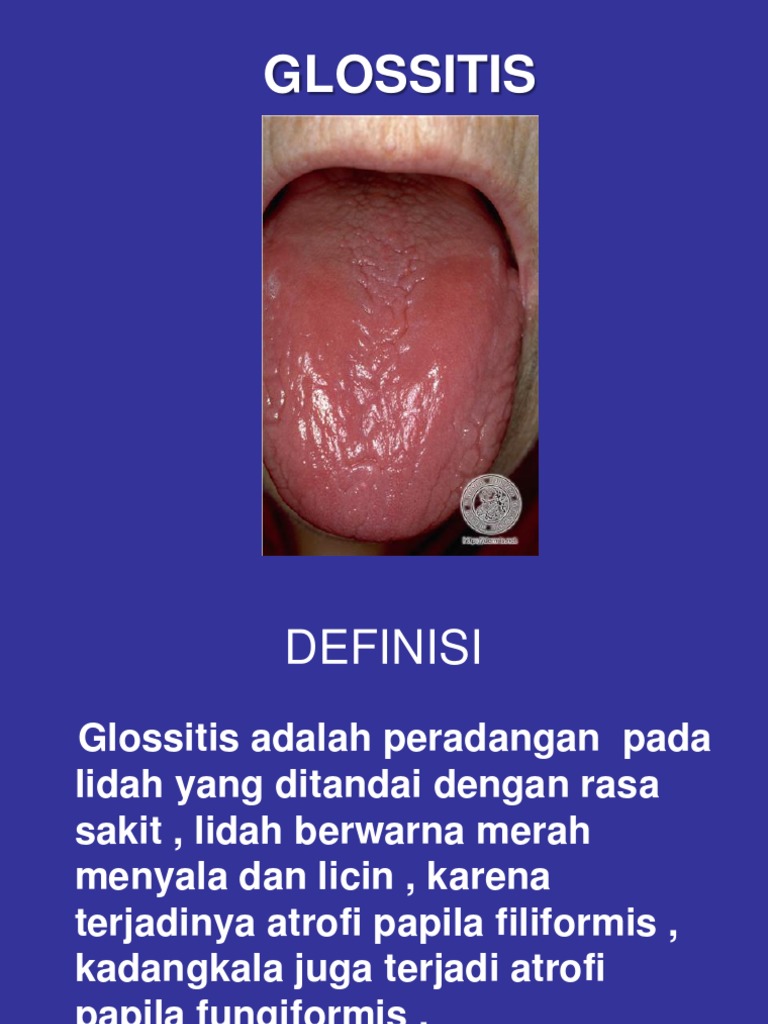 Glossitis | PDF